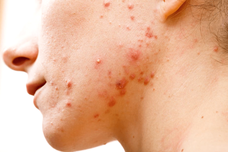 Acne & Congestion | Assessment & Treatment in Melbourne