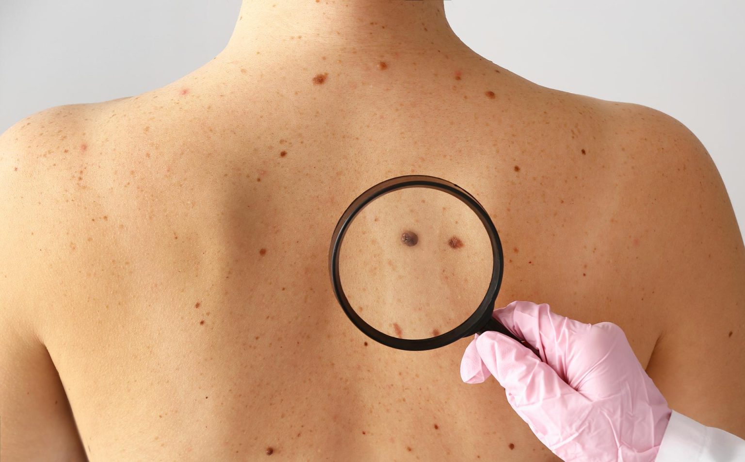 Skin Cancer Checks | Sun & Skin Medical Centre Melbourne