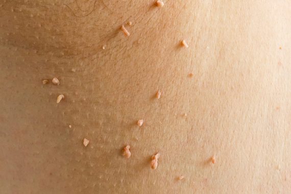 Skin Tags - Sun & Skin Medical Centre
