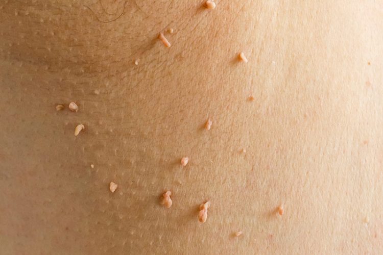 Skin Tags - Sun & Skin Medical Centre