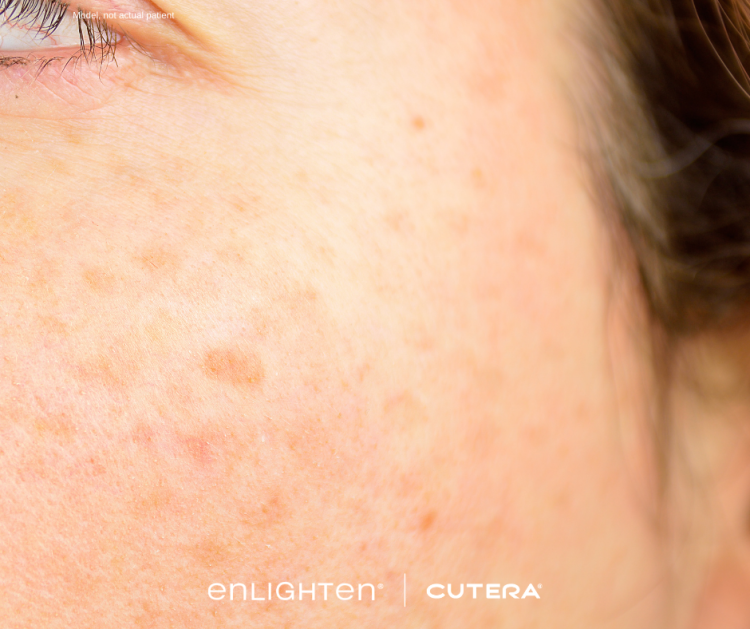 Sunspots - Sun & Skin Medical Centre