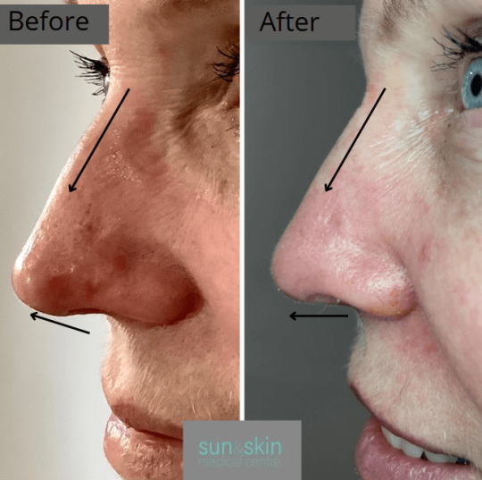 Nose Lift And Definition - Sun & Skin Medical Centre