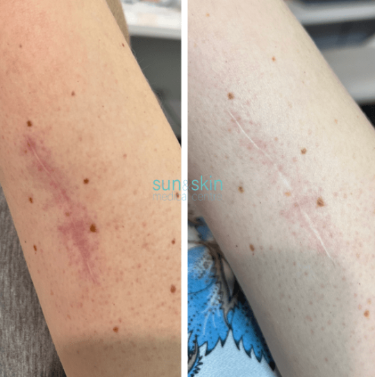 Skin Scarring Treatment | Mount Eliza Melbourne