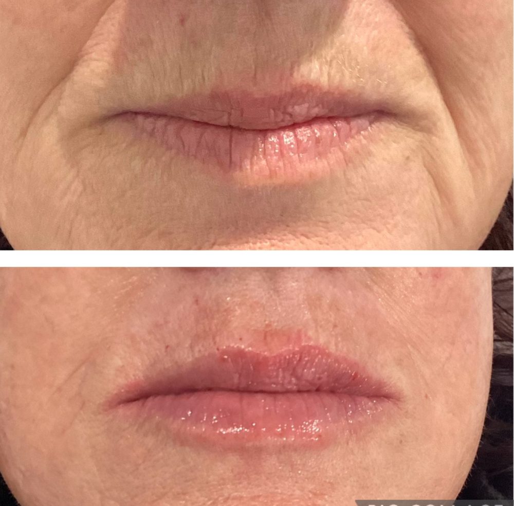 Smokers Lines - Sun & Skin Medical Centre